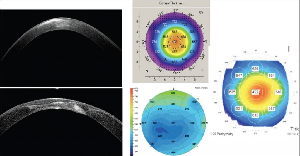 Testing for glaucoma | Glaucoma NZ