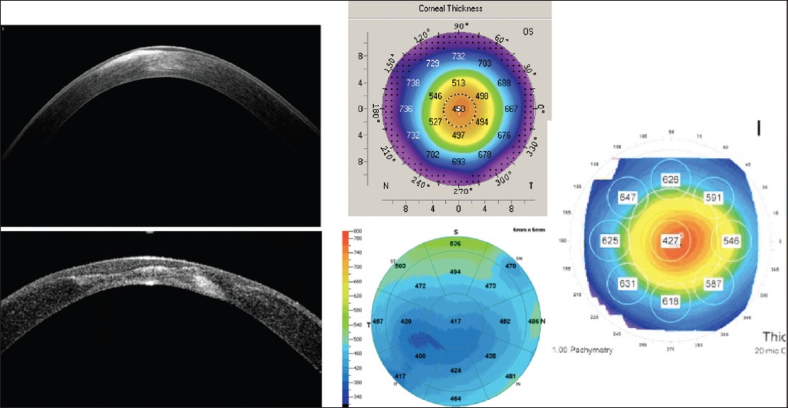 Testing for glaucoma | Glaucoma NZ